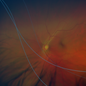 BVI Medical US – Vitreoretinal surgery equipments